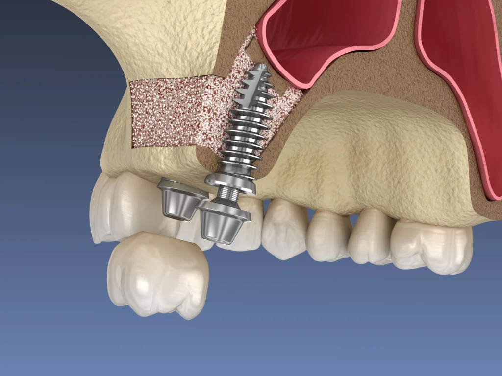 Sinus Lifts for Dental Implants | Kansas City Experts